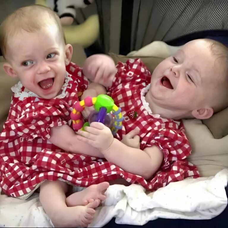 The conjoined twins joined at the chest were separated thanks to ...