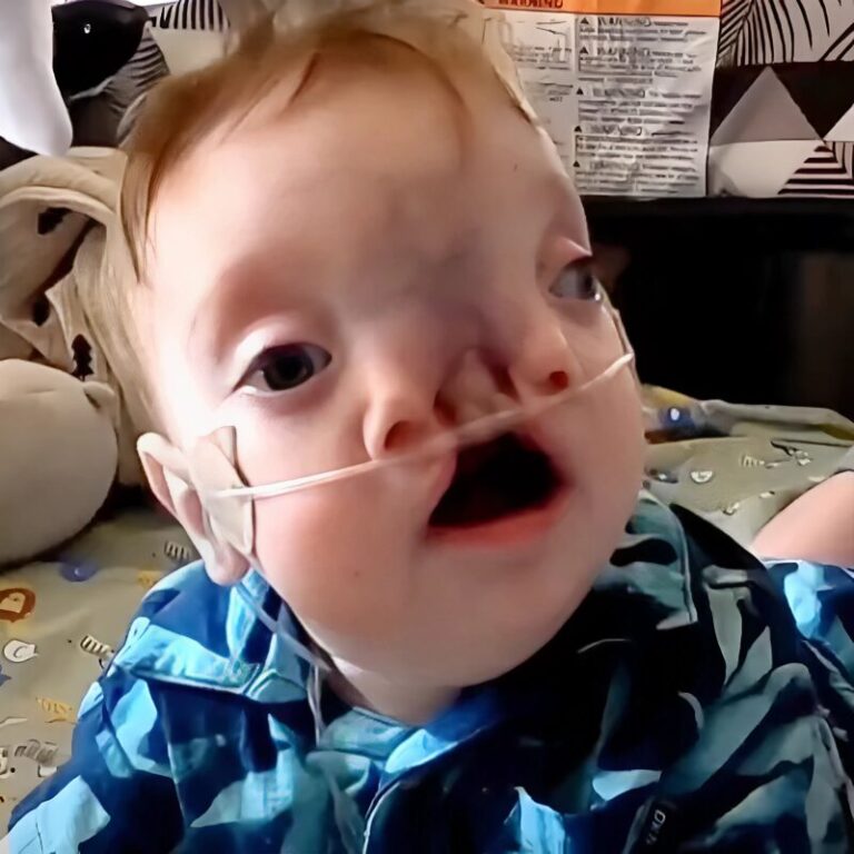 The child born with a facial deformity undergoes a major surgery, here ...
